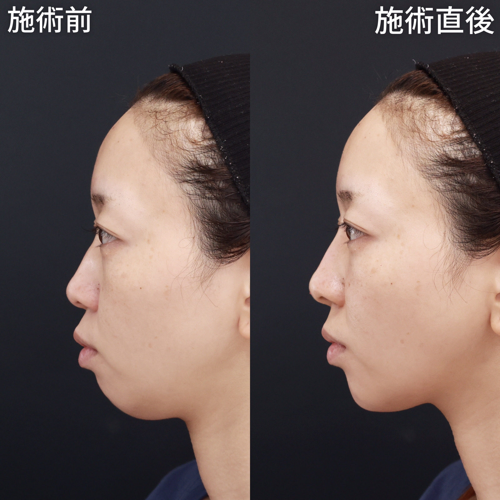 【ヒアルロン酸&切らない鼻中隔延長】メスを使わない“プチ整形だけ”でも、ここまで垢抜けます。|症例写真・ビフォーアフター|美容整形・美容外科の