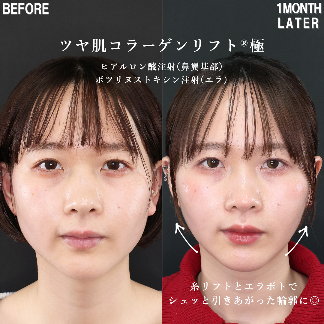 【糸リフト エラボト】ですっきり卵型フェイスに |症例写真・ビフォーアフター|美容整形・美容外科のtaクリニックグループ
