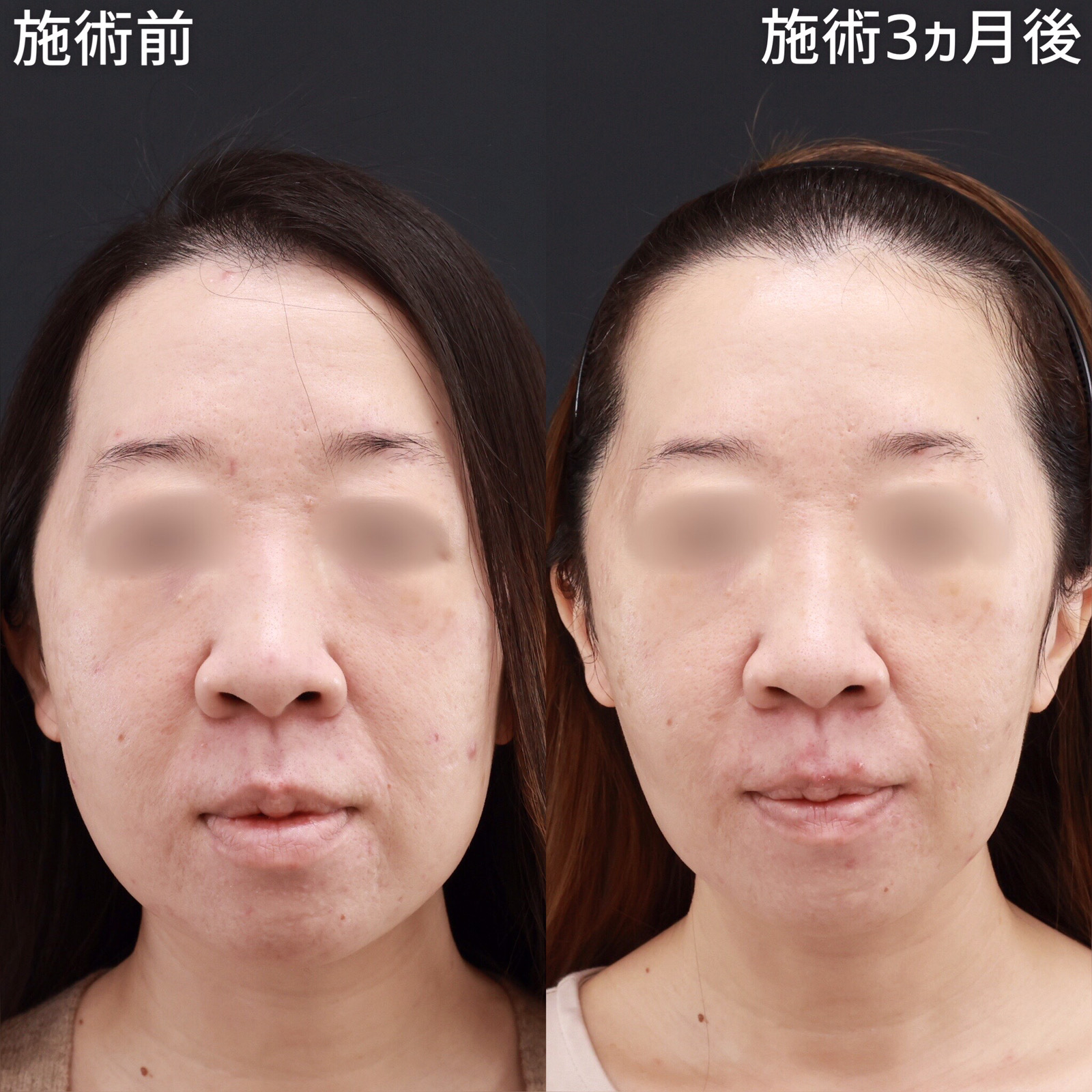 【脂肪除去のみ】加齢により落ちてきたお顔の脂肪をスッキリさせる！｜症例写真・ビフォーアフター｜美容整形･美容外科のtaクリニックグループ