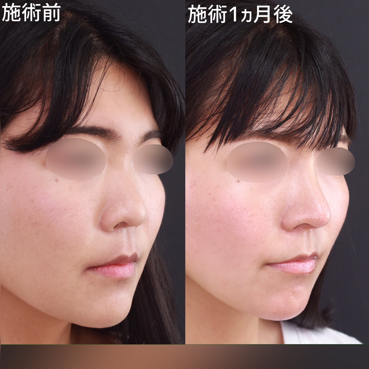 【鼻の複合施術】自分に合った理想的なお鼻へ|症例写真・ビフォーアフター|美容整形・美容外科のtaクリニックグループ