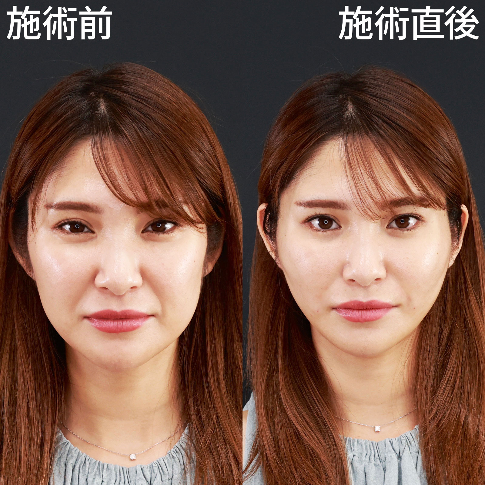 【小顔整形】輪郭のもたつき&ほうれい線も改善!直後から若々しく!|症例写真・ビフォーアフター|美容整形・美容外科のtaクリニックグループ