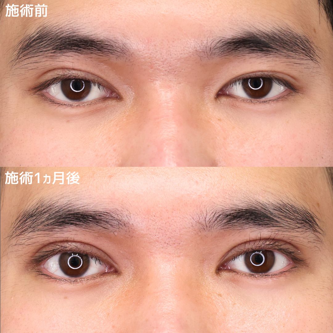 《二重全切開》切開術はdr藤橋にお任せ下さい|症例写真・ビフォーアフター|美容整形・美容外科のtaクリニックグループ