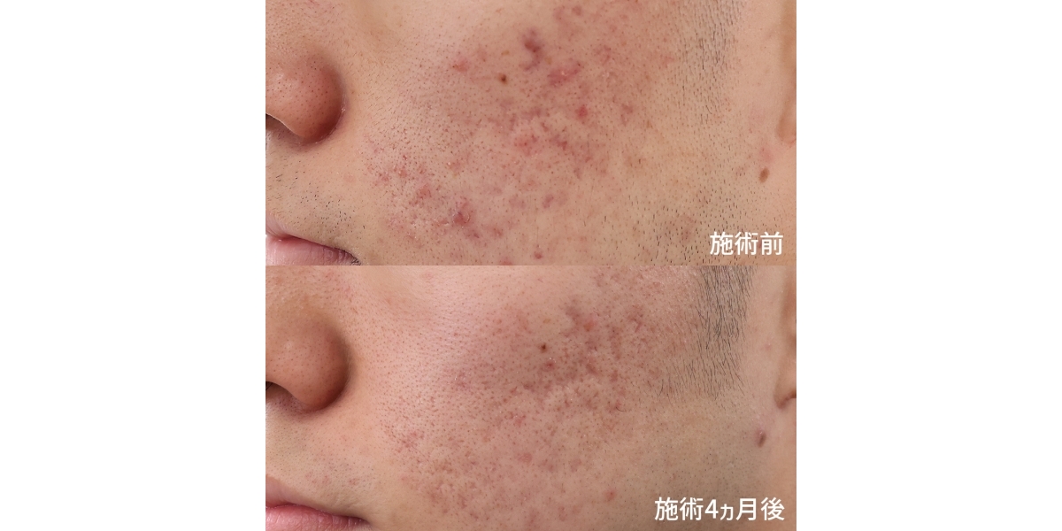 自身の血液でニキビ痕を改善!自然治癒力を促す【赤ヴァンパイアフェイシャル】|症例写真・ビフォーアフター|美容整形・美容外科のtaクリニックグループ